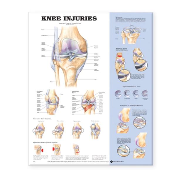 Wolters Kluwer Health Inc Chart Anatomical Knee Injuries 20X26" Ea - 9 ...