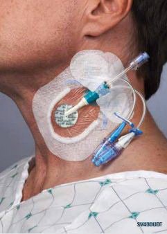 Sorbaview SHIELD - Integrated Securement Dressing Fabric / Film 3-3/4 ...